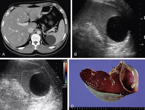 Focal Splenic Lesions Radiology Key