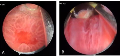 A The Cystoscopy Revealed Edematous Bladder Mucosa With Red Areas And Download Scientific