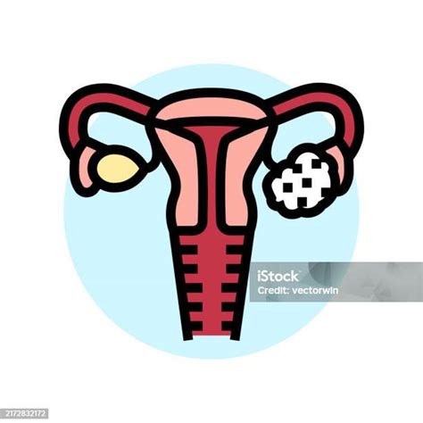 다낭성 난소 증후군 여자 질병 컬러 아이콘 벡터 일러스트 레이 션 건강관리와 의술에 대한 스톡 벡터 아트 및 기타 이미지