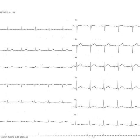 Electrocardiogram Ecg Ecg Showed Qt Prolongation A Which Had Not Download Scientific