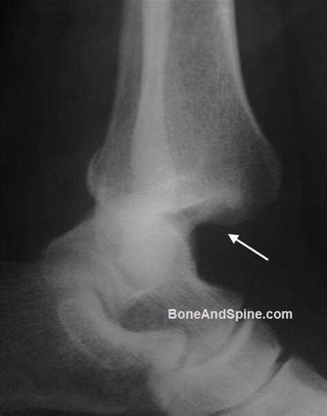 Ankle Dislocation Without Fracture Bone And Spine