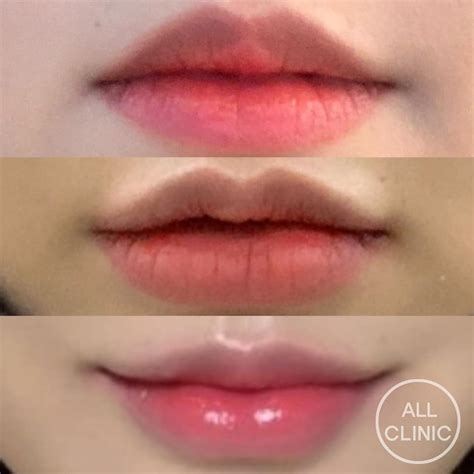 입꼬리입술필러 찐후기🎉 시술전☞1차시술☞리터치후 아름답게 변화된 명동 올클리닉 피부과성형외과