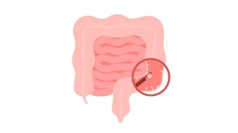 Colonoscopy Guide Procedure Preparation And Aftercare