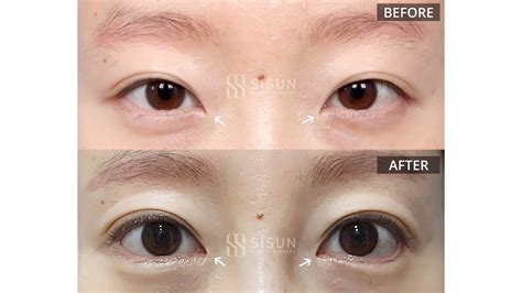 [무보정전후영상] 반달눈성형 갈고리눈 비절개눈매교정 갈고리트임 뒤트임 밑트임 1년4개월 Youtube