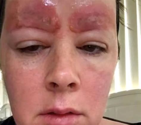 Woman Gets Terrible Infection After Microblading Her Eyebrows