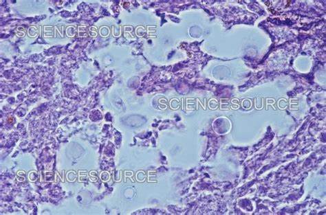 LM Of Cryptococcus Neoformans Stock Image Science Source Images