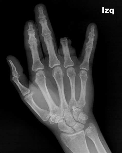 Amputation Hand Buyxraysonline