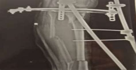 Segmental Tibia Fracture With Hybrid External Fixator Download Scientific Diagram