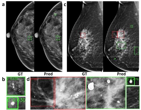 Artificial Intelligence Based Diagnosis Of Breast Cancer By Mammography