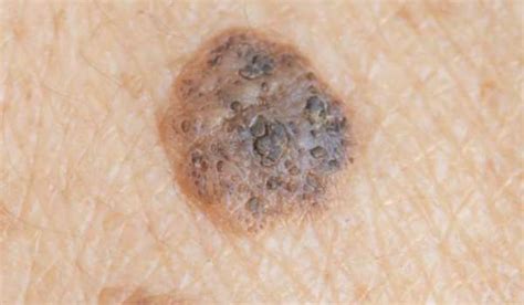 Seborrheic Keratosis Vs Melanoma Vujevich Dermatology