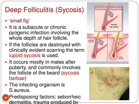 Staphylococcal And Streptococcal Skin Infections