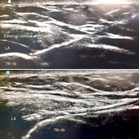 Weng Ken C On Linkedin Raukm Eoiblock Eoicatheter