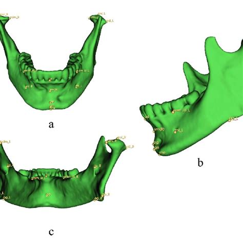 Soft Tissue Landmarks For 3d Analysis Definitions Are Provided In Download Scientific Diagram