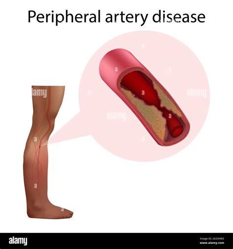 La enfermedad arterial periférica ilustración Fotografía de stock Alamy