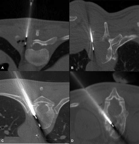 A And B Axial Ct Images Demonstrate Vertebral Lesion Biopsy By