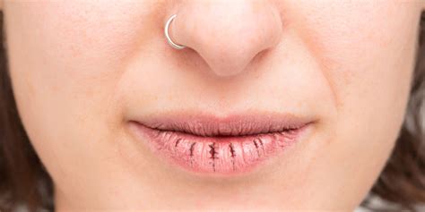 Best Remedies For Chapped Lips Top 16 Solutions