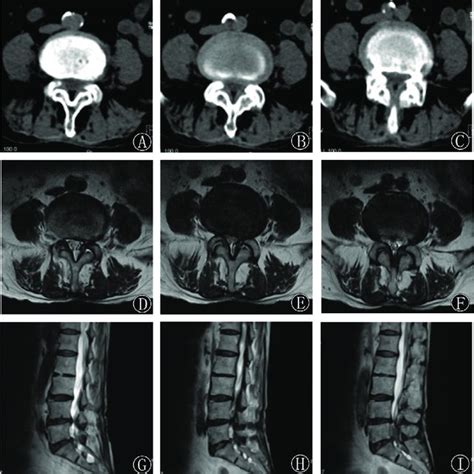 A C Preoperative Consecutive Axial CT Images Showed Facet Joint Download Scientific Diagram