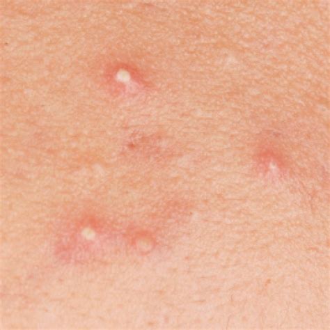 Pimple Correct Hero Cosmetics