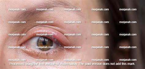 أسباب إنتفاخ جفن العين وعلاجه مرجانة