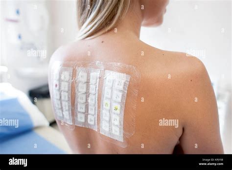 Patch Test Allergy Hi Res Stock Photography And Images Alamy