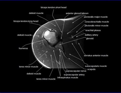 Shoulder Anatomy Mri Shoulder Axial Anatomy Free Cross Sectional Anatomy Medical Imaging