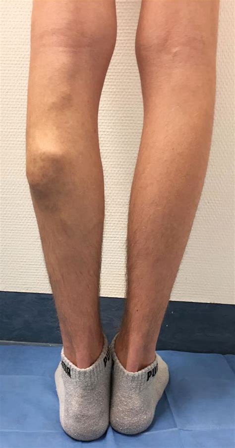 Arteriovenous Malformation Leg