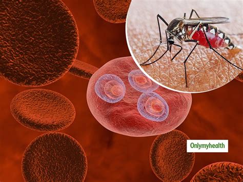 Possible To Eradicate Malaria From India Says Uk Medical Journal
