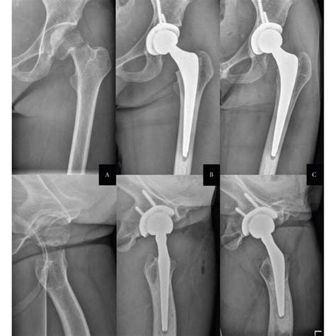 Anteroposterior And Axial Radiographs Of The Left Hip From Case One At