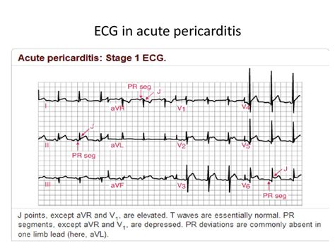 Pericardial Diseases презентация онлайн