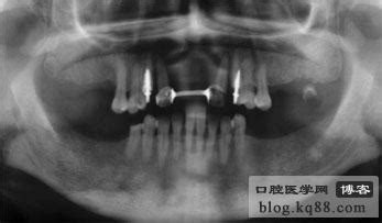 牙槽嵴裂 牙槽嵴裂植骨后图片 大山谷图库