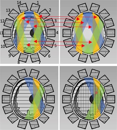 unsupervised algorithm for brain anomalies localization in