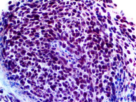 Sarcoma Archives Bio Sb