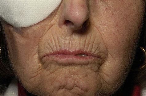 Table 1 From Ocular Manifestations Of Scleroderma Semantic Scholar