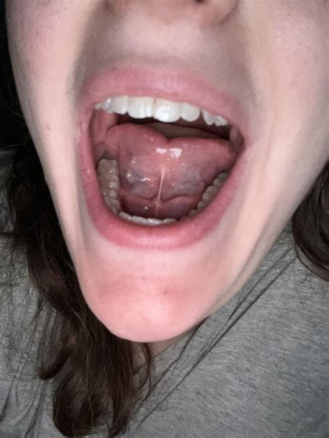 Is This A Tongue Tie Rtongueties