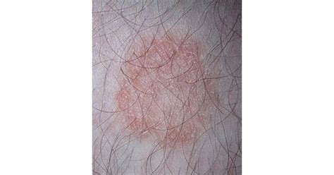 Helios Homeopathy Shop Ringworm