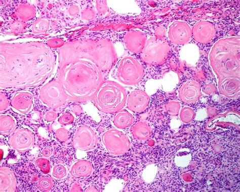 Velum Interpositum Meningioma At Irving Sandoz Blog
