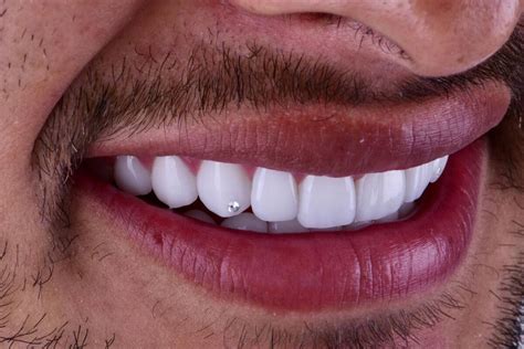 Cuánto Cuesta La Incrustación De Diamantes En Los Dientes Como Las Que