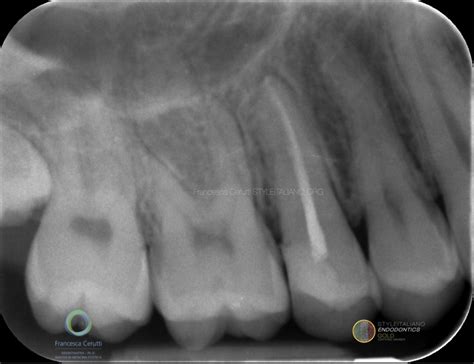 Endo Resto Management Of A Poorly Treated Premolar Style Italiano