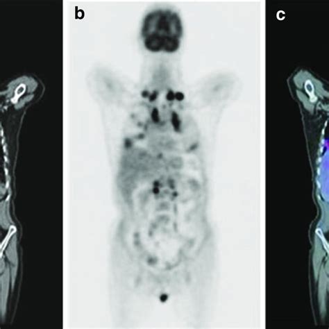 1 Types Of Pelvic Exenteration A Anterior B Posterior C Total