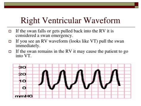Right Ventricular Pressure Waveform