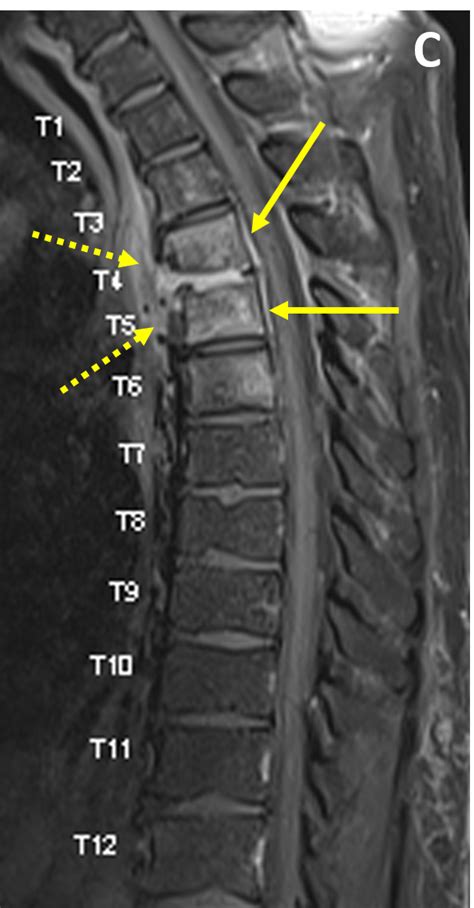 Spinal Epidural Abscess Sea Mri Online Medality