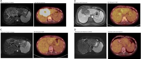 Selective Internal Radiation Therapy Sirt With Yttrium 90 Microspheres For Unresectable