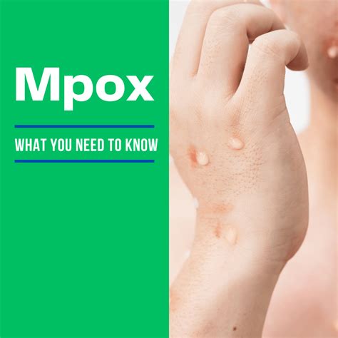 New Clade Ib Mpox Case In England What You Need To Know Healthymt