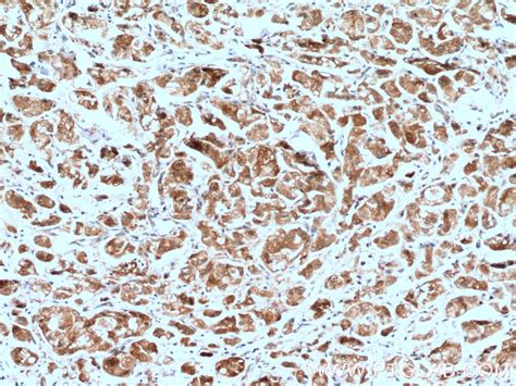 Neurofibromin 1 Antibody 27249 1 Ap Proteintech