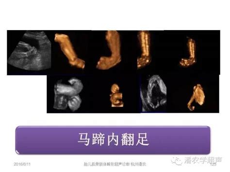 胎儿肌骨和肢体畸形超声诊断思路四肢畸形手畸形足畸形