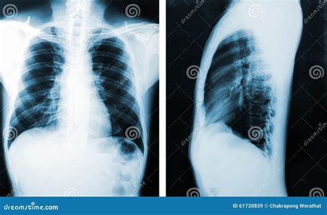 Radiologiczny Wizerunek Widok Klatka Piersiowa Mężczyzna Dla Medycznej