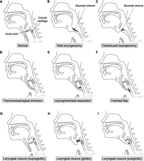 Schemas For Various Aspiration Prevention Surgeries A Normal B Total