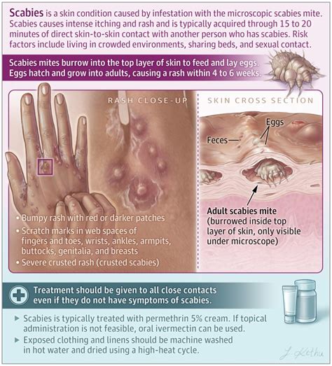 Jama Scabies Is Caused By A Microscopic Mite That Burrows Into The
