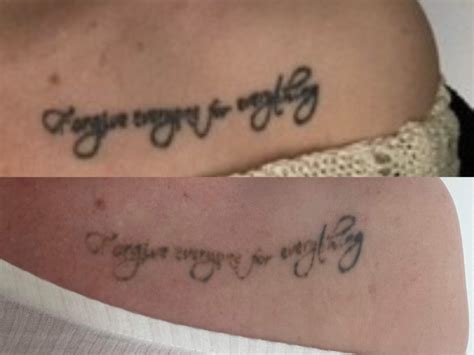 Fjernelse Af Tatovering Cme Skin