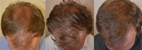 Four Year Finasteride Hair Thickening Result Hair Restoration Of The